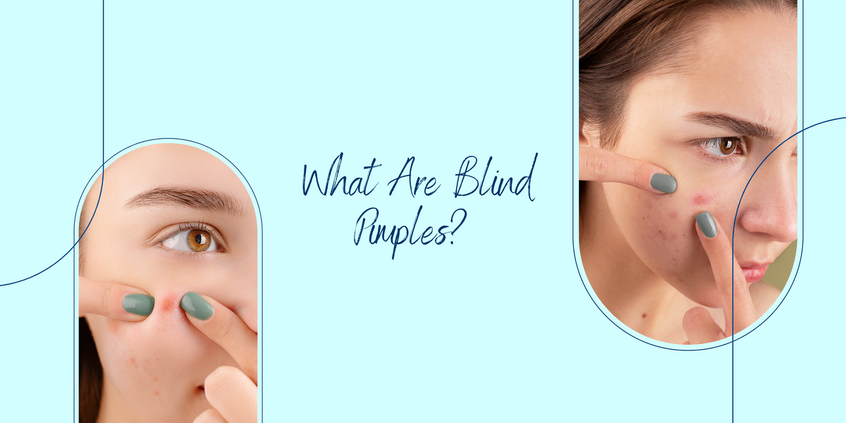 What Are Blind Pimples? – Threebs Malaysia | Health & Beauty Products
