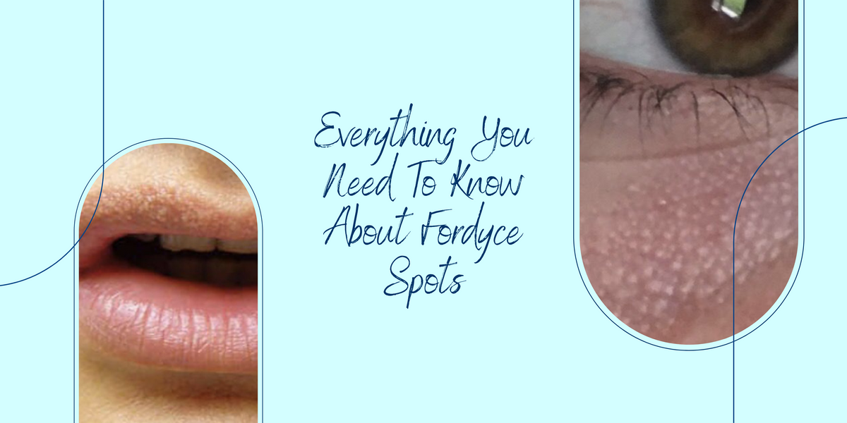 Everything You Need To Know About Fordyce Spots – Threebs Malaysia ...