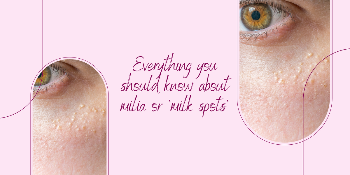 Everything You Should Know About Milia Or 'Milk Spots' – Threebs ...