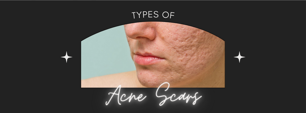 Know The 5 Types Of Acne Scars? – Threebs Malaysia | Health & Beauty ...